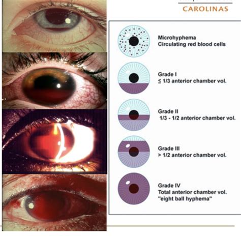 Traumatic Iritis Slit Lamp