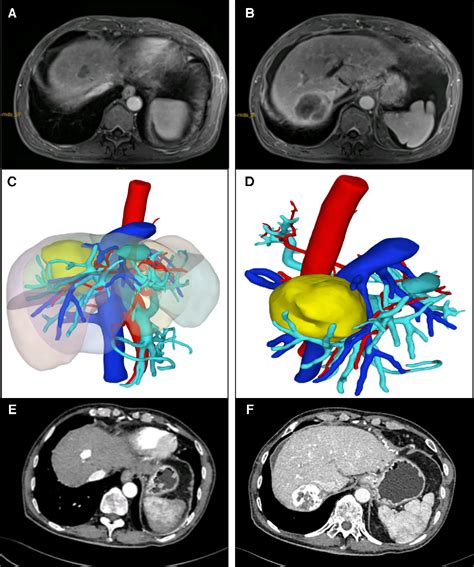 Figure 2 From Downstaging And Laparoscopic Hepatectomy Plus Intraoperative Radiofrequency