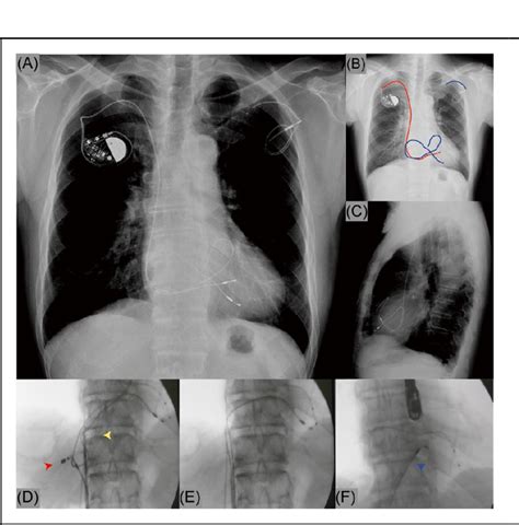 A Chest Radiograph Shows The Alpha Looped Broken Pacemaker Lead B