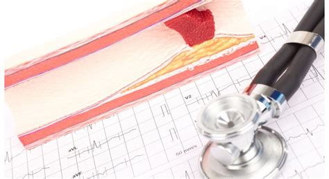 Helpful App — Indications For Coronary Artery Bypass Graft Cabg
