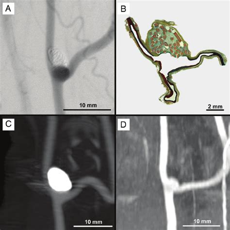 Dsa A Histologic B Cta C And Mra D Imaging Of An