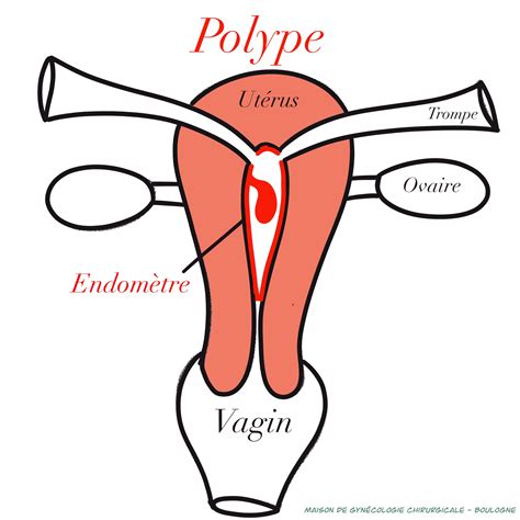 Polype Maison De Gynécologie Chirurgicale