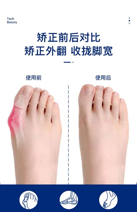 엄지 발가락 교정기 엄지 외반 실리콘 분할 발가락 착용 가능한 신발 교정 유물 어머니의 발 어린이 어린이 남성과 여성 치허