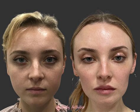 Masseter Reduction Botox Before And After See The Powerful Transformation