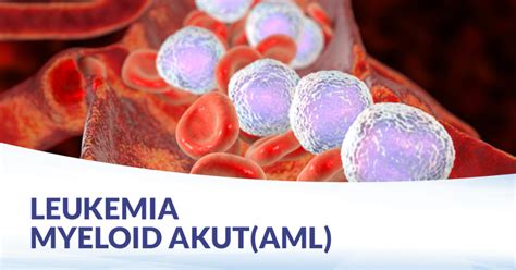 Leukemia Myeloid Akut Cfch Centre For Clinical Haematology