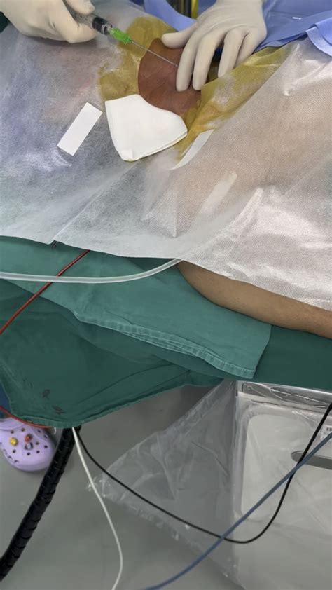 颈内静脉穿刺视频 丁香园论坛