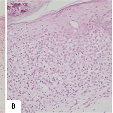A Spongiotic Epidermis With Foci Of Basal Hydropic Degeneration