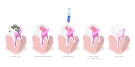 370 Root Canal Treatment Illustrations Free Download In Svg Png Eps