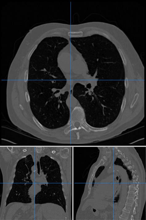 Example Of A Ct Dicom Image It Can Be Seen That The Thoracic Region Is