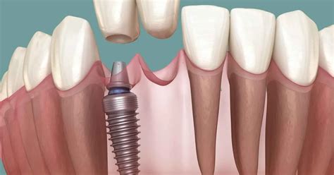 Surgical Periodontal The Long Term Benefits Of A Fixed Tooth Prosthesis