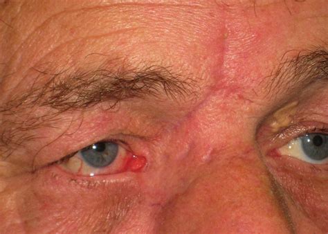 Eyelid Skin Cancers Eyelid Bcc Mr David Cheung Eyelid Specialist