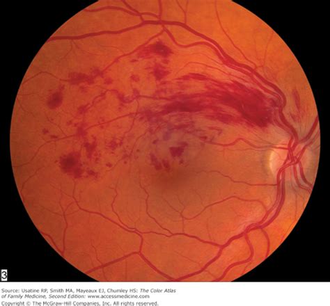 Hypertensive Retinopathy Images