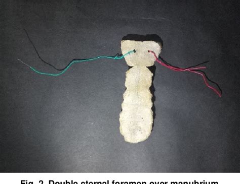 Figure 1 From A Comprehensive Study Of Sternal Foramen In Dry Sternum