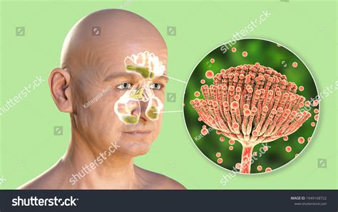 Aspergillus Fungi Cause Sinusitis 3d Illustration Stock Illustration