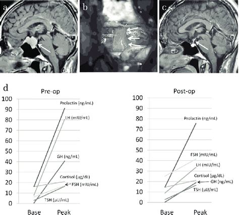 A 47 Year Old Woman With Tuberculum Sellae Meningioma A Preoperative