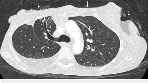 The Sagittal Cross Section From The Computed Tomography Ct Of The Download Scientific Diagram