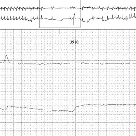 Holter Electrocardiogram With Third Degree Atrioventricular Block And