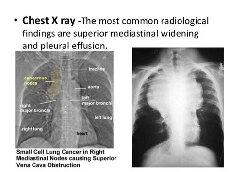 Superior Vena Cava Syndrome
