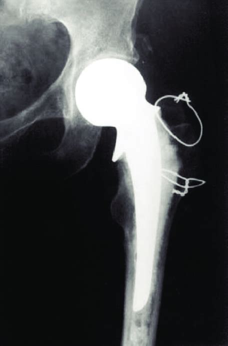 Radiograph Of A Bipolar Prosthesis Download Scientific Diagram