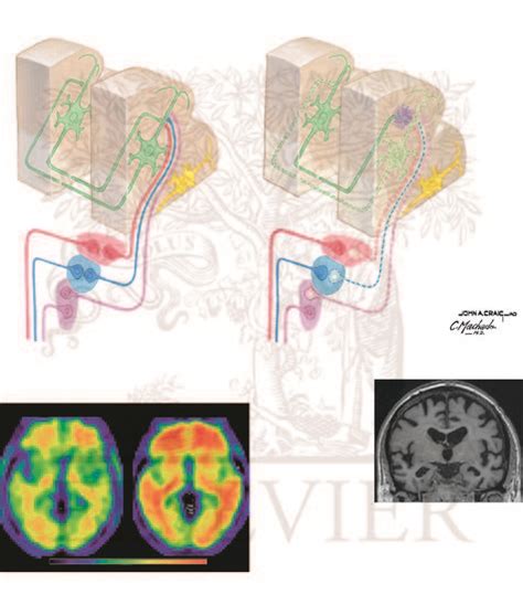 Alzheimers Disease Pathology