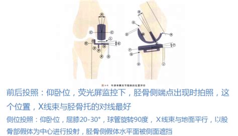 保膝！牛津uka手术胫骨侧假体后倾角如何才能更好地做到标准7°截骨？ 会议中心