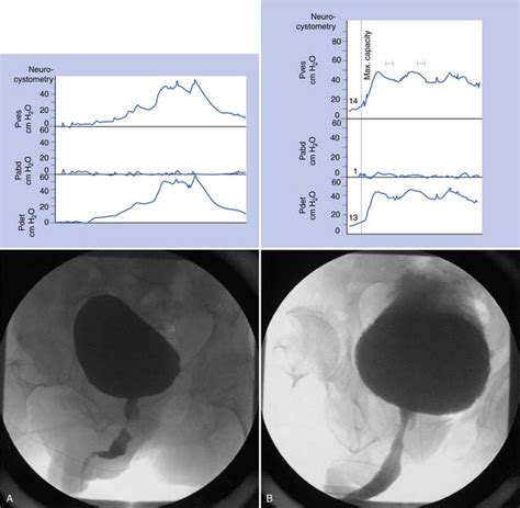 Management Of Bladder Dysfunction Clinical Gate