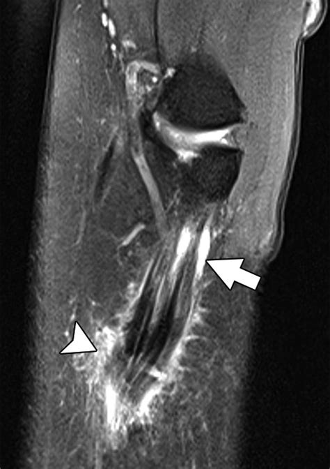 De Quervains Tendonitis Mri