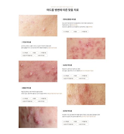 여드름클리닉 청담준의원 중랑구 구리 상봉역 여드름 치료 피부과 추천 유명한 잘하는곳 원인 증상별 다양한 치료 프로그램