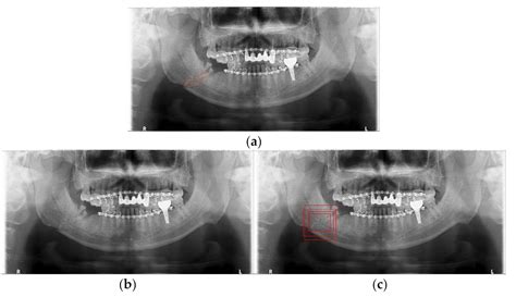 Automatic Detection Of Mandibular Fractures In Panoramic Radiographs
