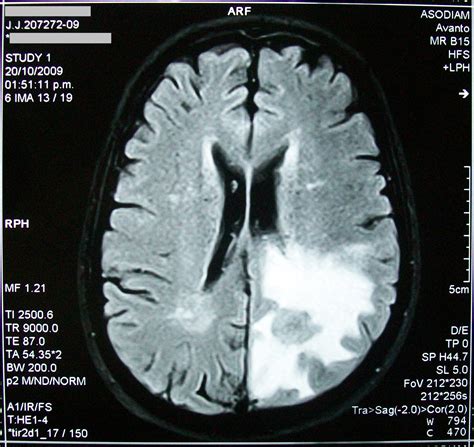 File Mri Brain Tumor  Wikimedia Commons
