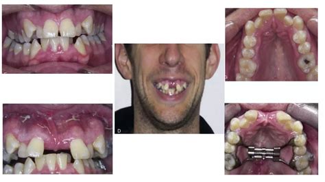 Surgically Assisted Rapid Palatal Expansion Sarpe Pptx