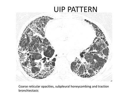 Ppt Interstitial Lung Disease Powerpoint Presentation Free Download