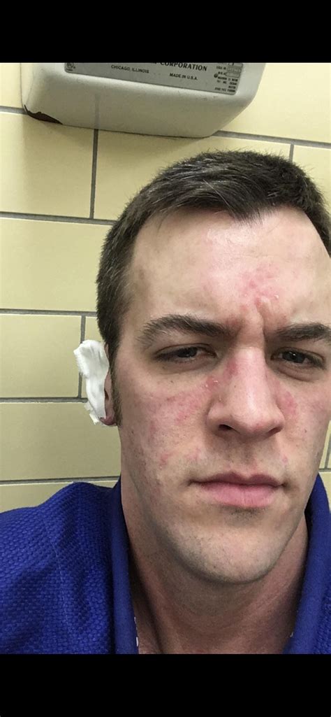 6 Month Update On Taltz R Psoriasis