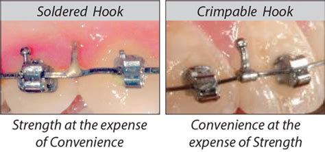 Speed System Orthodontics