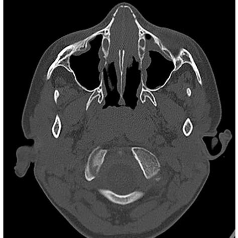 Ct With A Bone Window Confirms The Absence Of Bone Lysis Download