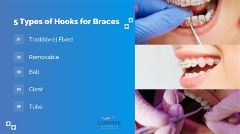 Braces Hooks Rubber Bands At Eileen Porras Blog