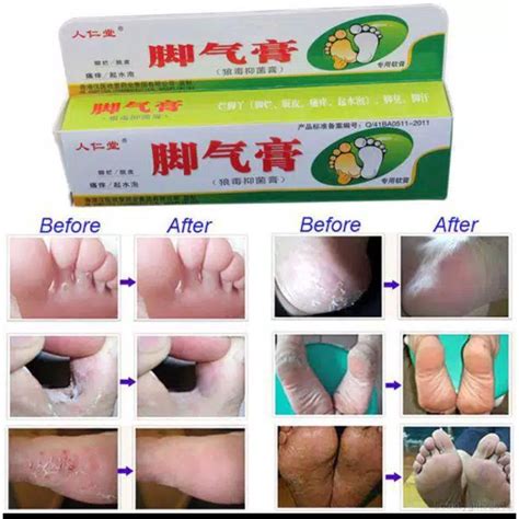 Jual Obat Kutu Air Gatal Di Kaki Paling Manjur Pecah Apotik Ciwe Shop