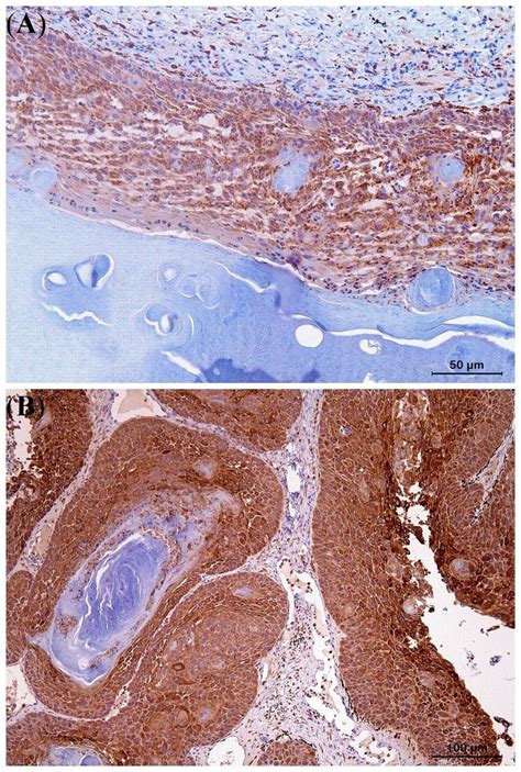 Moderate Intracytoplasmic Cox 2 Staining Of A Keratoacanthoma Ka From