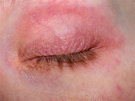 Rash Around Eyes Causes Symptoms And Treatment