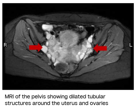 Pelvic Venous Disorder Previously Called Pelvic Congestion Vein