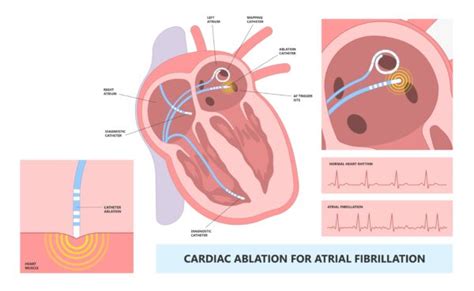 Cardiac Ablation Capital Heart Centre