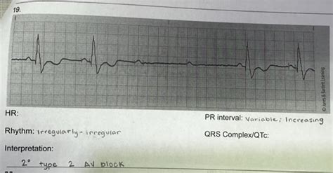 Solved Rhythm Irregularly Irregular Interpretation 2∘