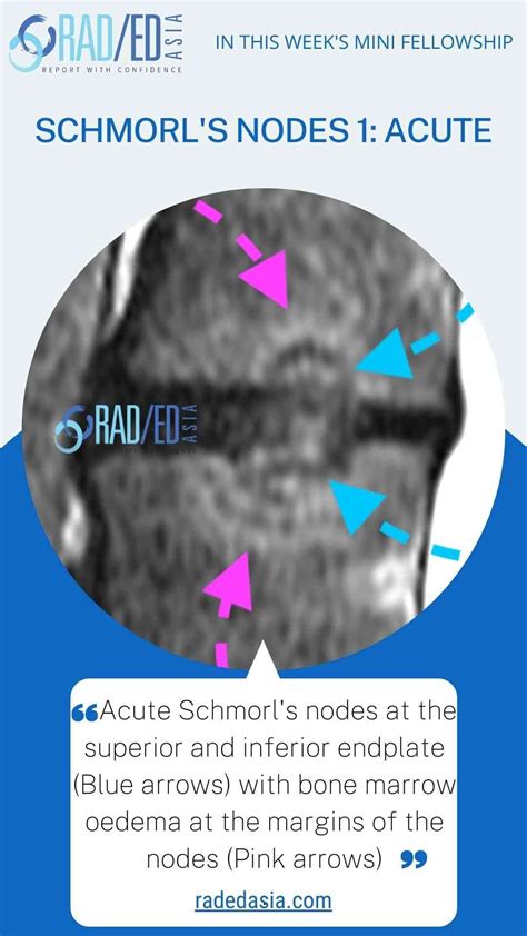 Schmorls Node On Spine Mri Acute And Chronic Schmorls Nodes Mri