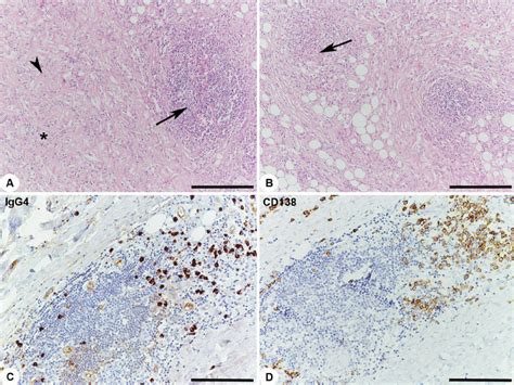 Pathology Of Idiopathic Retroperitoneal Fibrosis A Idiopathic