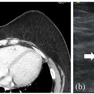 A Contrast Enhanced Computed Tomography Shows Enhanced Solid Mass