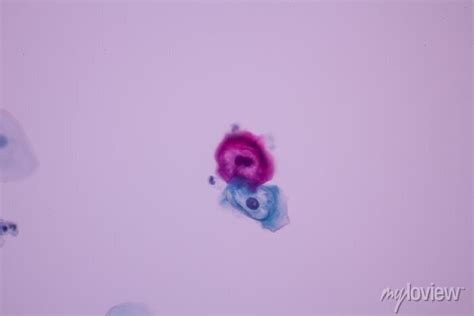 View In Microscopic Of Abnormal Human Cervix Cells Koilocyte • Wall Stickers Woman Virus