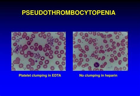 Ppt Thrombocytopenia Powerpoint Presentation Id608609