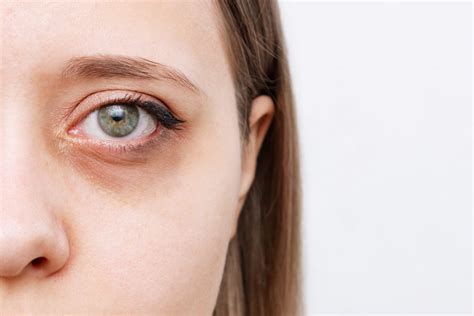 Dark Eye Circles Treatments Eyebag Doctor Singapore