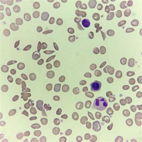 Elliptocytes Ovalocytes Appearance And Clinical Significance Medlabbuddy