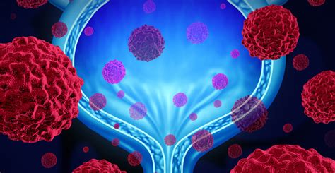 Bcg Instillations Urologic Oncologist Dr Michael Daneshvar Uci Urology